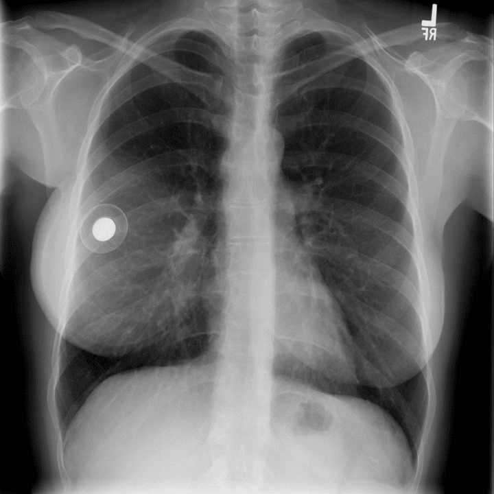 Chest X-rays - SO Development