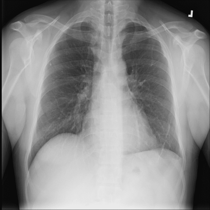 Chest X-rays - SO Development